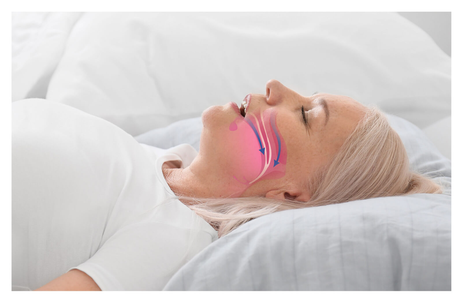 Everything to Know About Laser Treatment for Snoring
